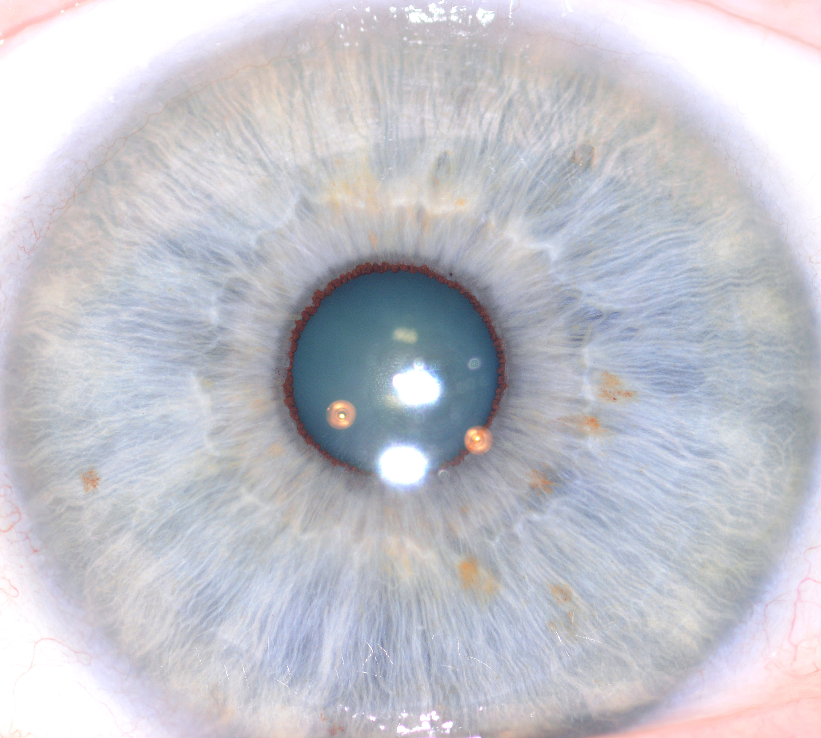 Custom Iridology Camera Systems | Iris Imaging Systems
