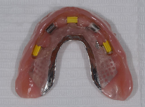 Upper implant-retained dentures Cardiff | DentalImplantsWales
