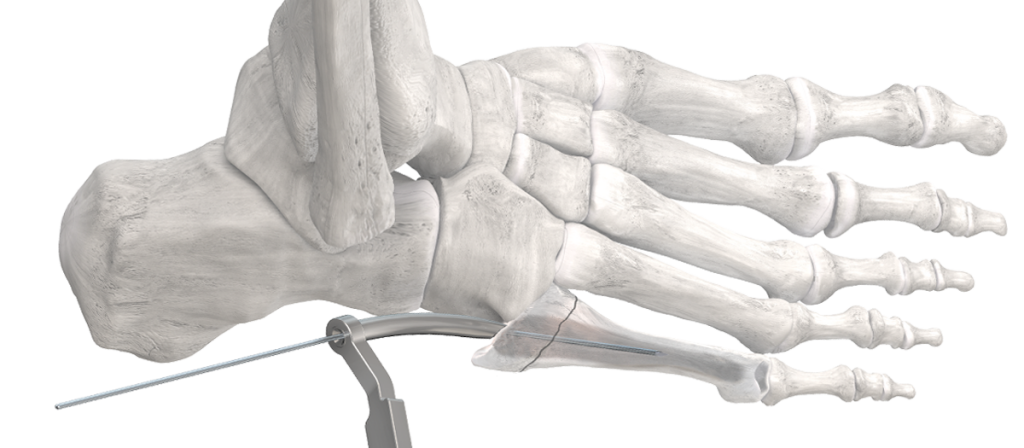 Precision® Jones Fracture Screw System