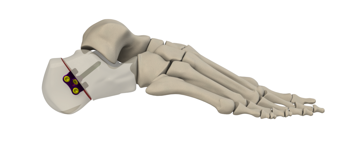 Calc Slide Plate R3con Plating System™