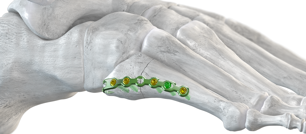 Baby Gorilla® 5th Metatarsal Plating System