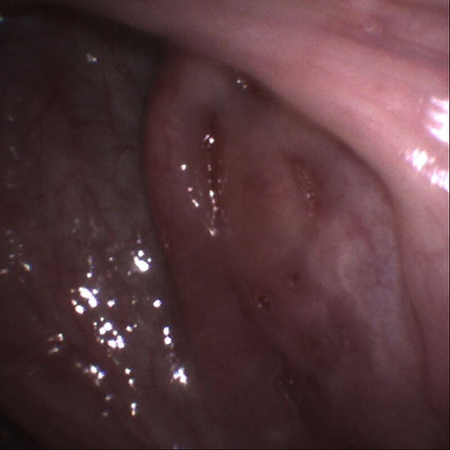 tonsil carcinoma