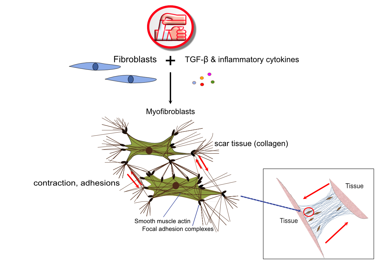 Active and Residual Arthrofibrosis