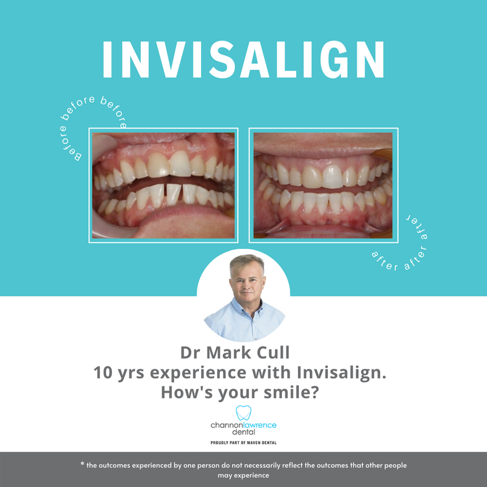 Invisalign® Cost | 5 Things You Need To Know About Invisalign