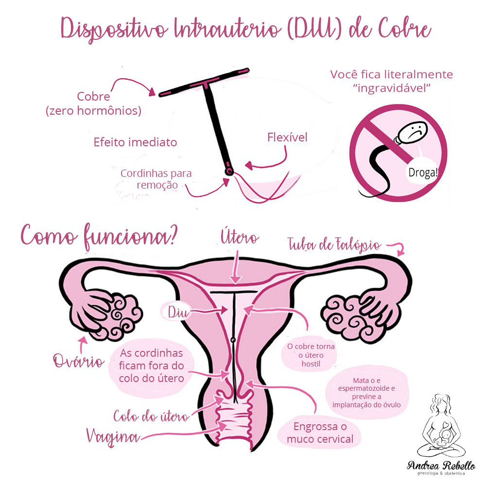 DIU DE COBRE - MÉTODO CONTRACEPTIVO NÃO HORMONAL