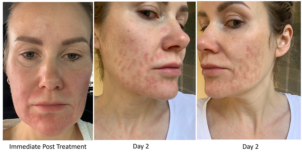 Clear Lift Laser Skin Rejuvenation and iPixel Laser Skin Resurfacing at ...