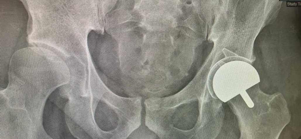 Hip Resurfacing is recognized as a key milestone in healthcare and ...