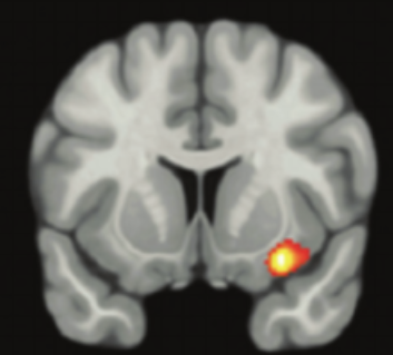 Dissociative Identity Disorder and Its Impact on the Brain