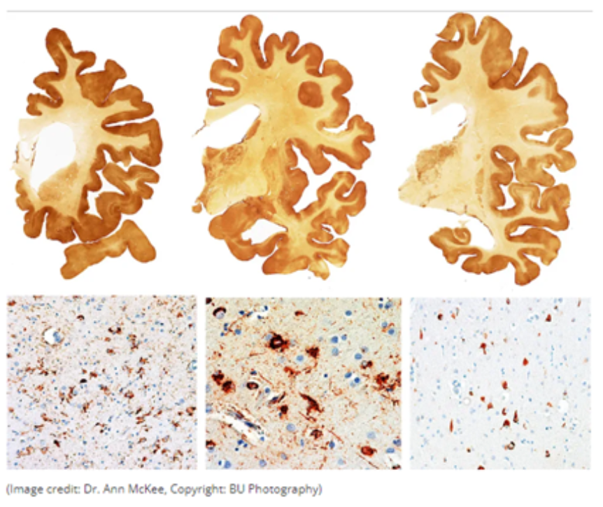 NFL Football & Chronic Traumatic Encephalopathy (CTE): An Overview