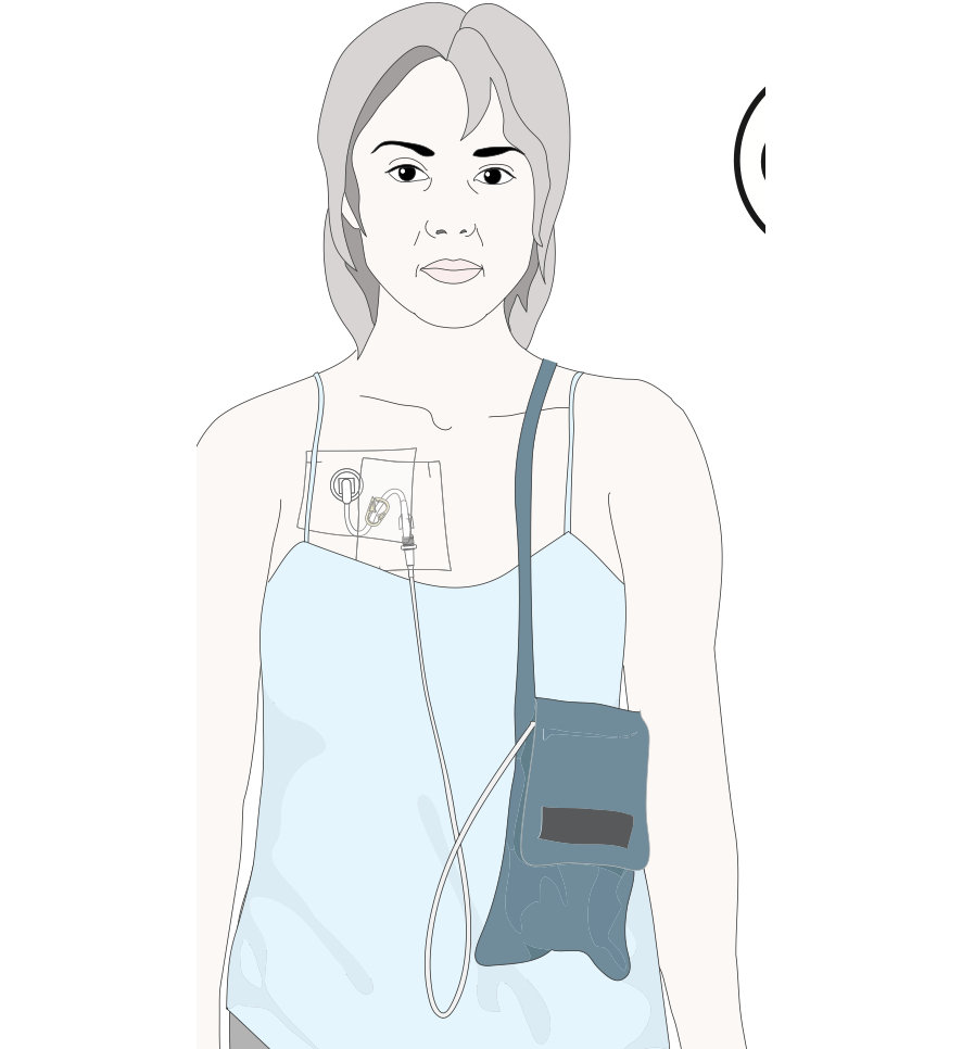 Comment fonctionne l'infuseur pour chimiothérapie?