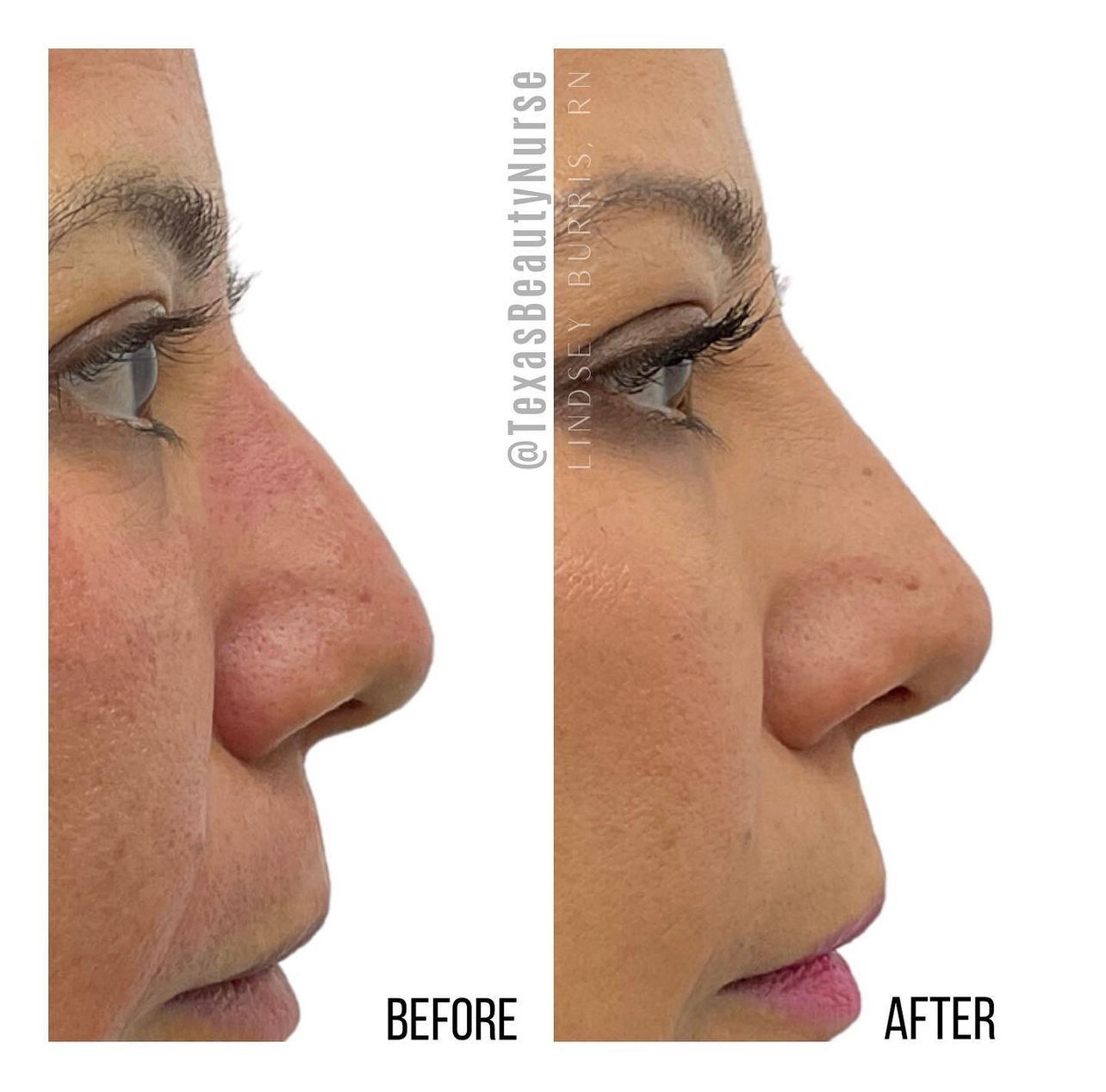 Liquid Rhinoplasty in McKinney, TX | Hartwater Aesthetics