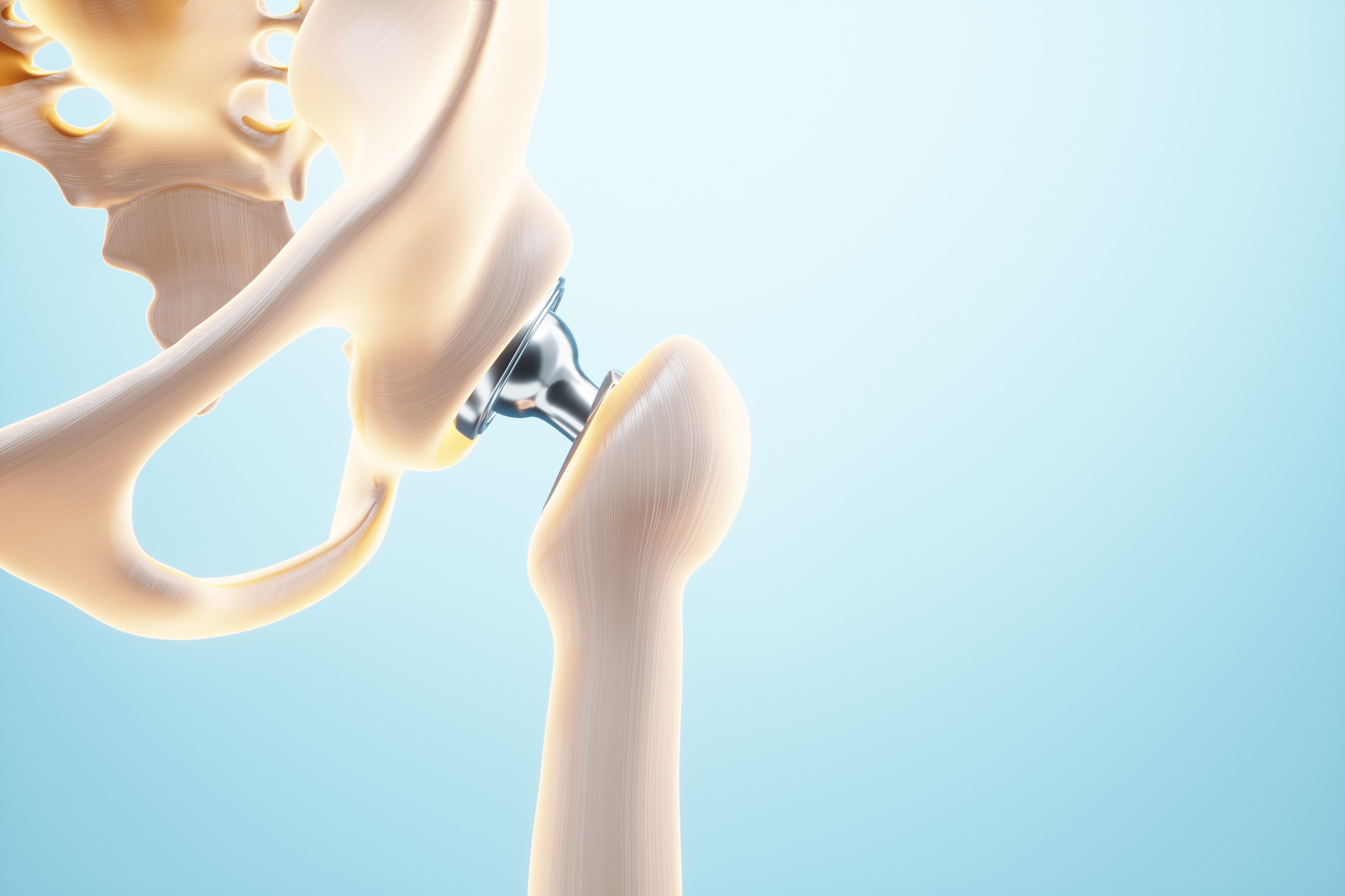 Pilates for Hip Replacement Rehabilitation: A Global and NHS-Informed ...
