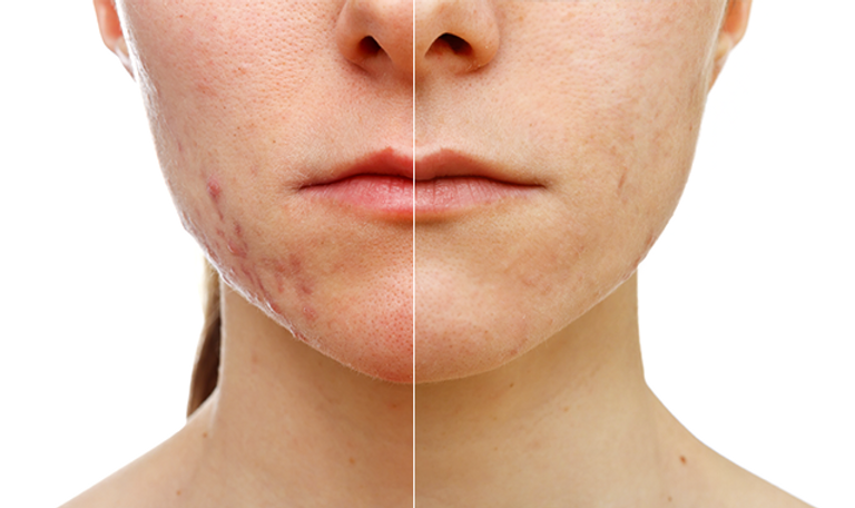 Case study: scar treatment with PRP therapy