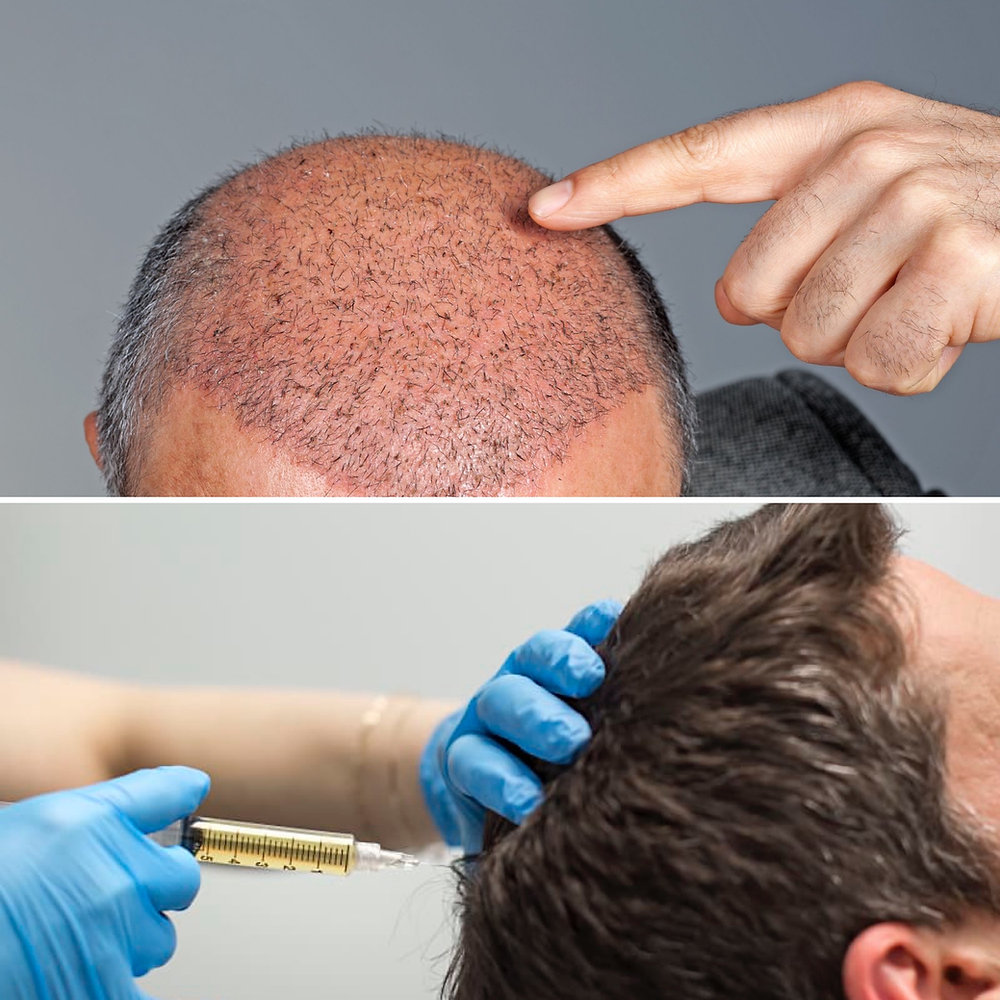 Prp Treatment After Hair Transplant Dynamic Regenerative Medicine