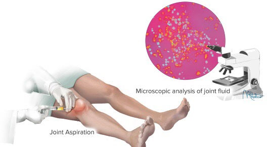 Knee Aspiration Treatment Birmingham (Knee Draining From Swelling)