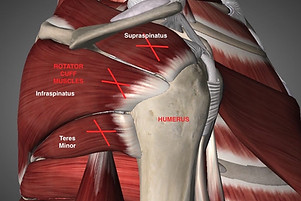 Rotator Cuff Injury Birmingham & Solihull - Shoulder Pain Treatment