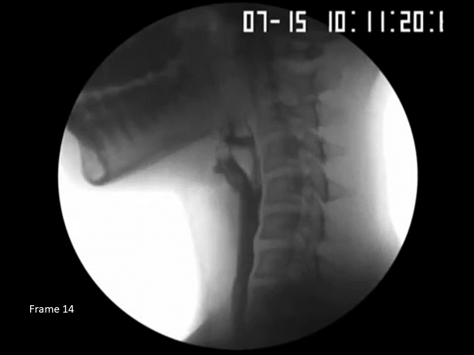 Video-fluoroscopy | SLPQuest