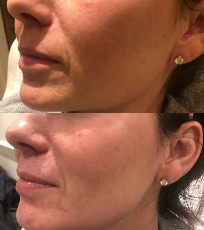 A SLIMMER, MORE DEFINED FACE COULD BE JUST A FEW BOTOX INJECTIONS AWAY