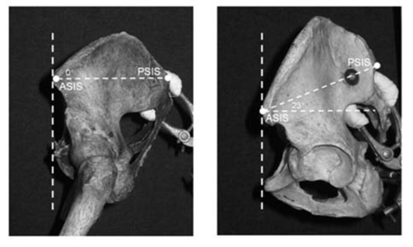 08. Anterior pelvic tilt. Beware