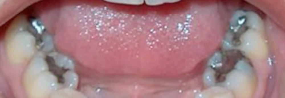Mercury Dental Fillings