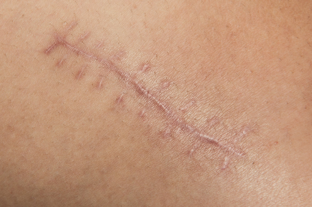 Unveiling the Hidden Consequences: How Scars Disrupt Electrical ...