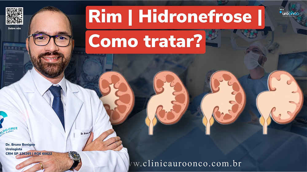 Hidronefrose: Um Problema Silencioso que Pode Afetar o Rim! Como ...