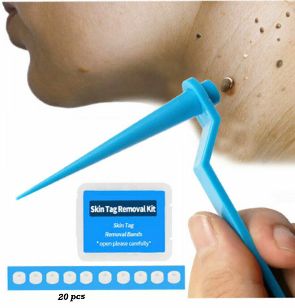 Micro Sets Skin Tag Remover Device Kit For Small To Medium Skin Tags ...