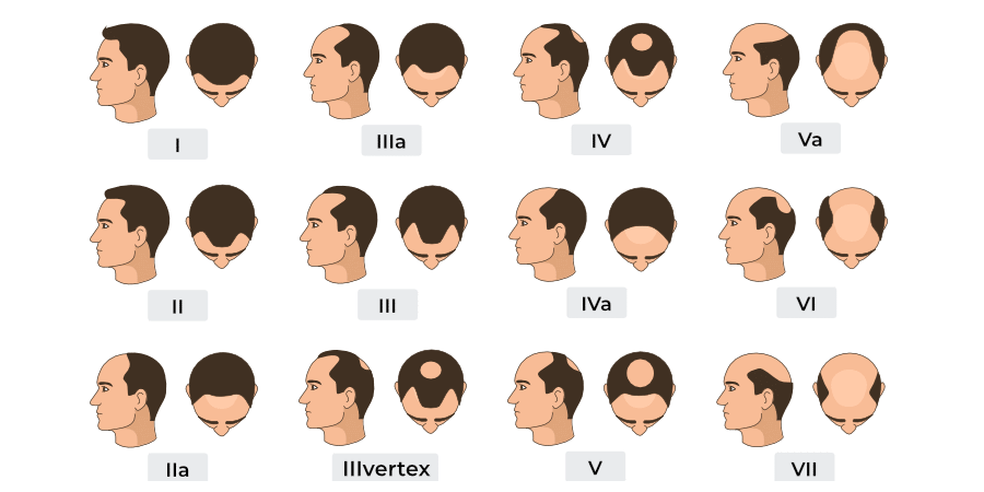 The Norwood Scale - Ultimate Guide