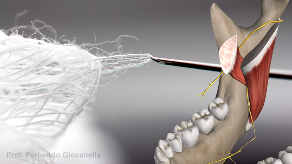 Trismo após anestesia local: Por que acontece, como prevenir e tratar