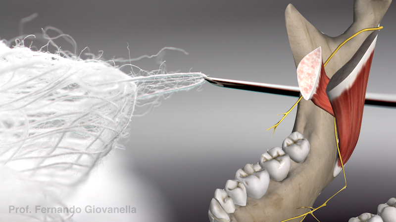 Trismo após anestesia local: Por que acontece, como prevenir e tratar