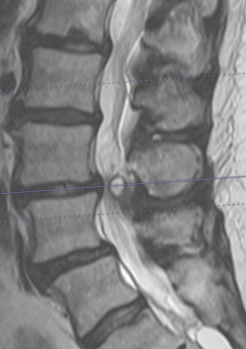 Facetgewrichtcyste | Hernia weg