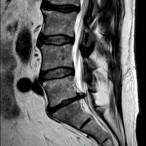 Hernia L5-S1 | Wat is een hernia L5/S1? | Hernia weg