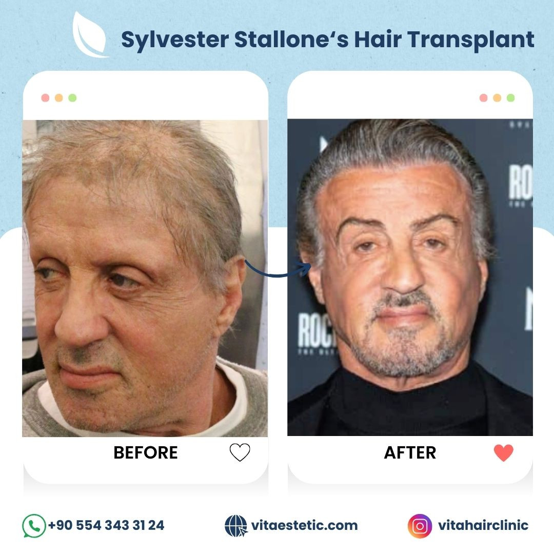 Sylvester Stallone Hair Transplant Journey: Subtle Changes Behind the ...