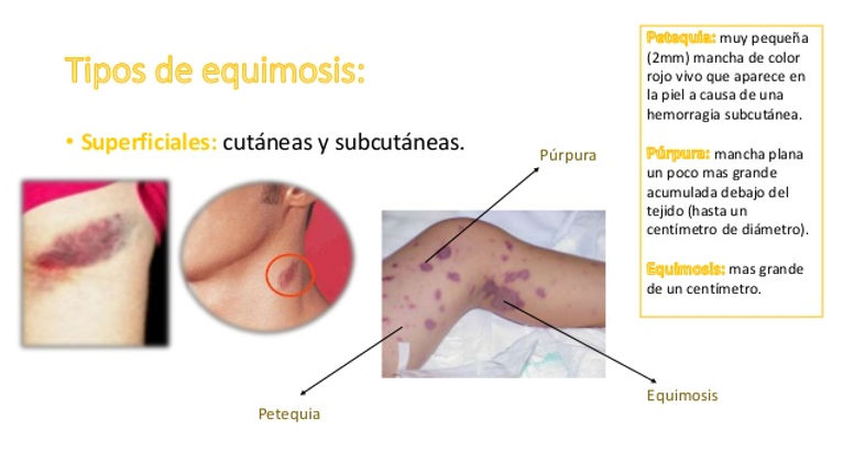 equimosis que es