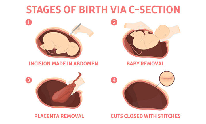 Whats Better Natural Birth Or A C Section