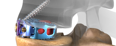 CTL Amedica: Innovative Spine Surgery Solutions | Addison, TX