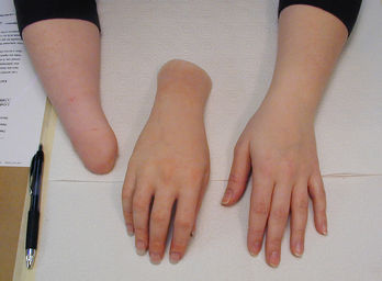 Alternative Prosthetic Services