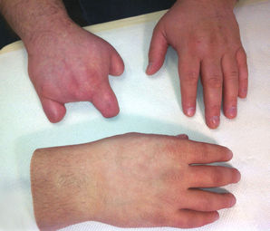 Alternative Prosthetic Services