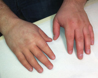 Alternative Prosthetic Services