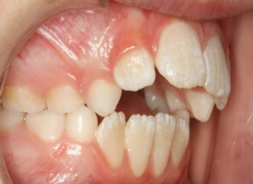 How We Treat Prolonged Thumb Sucking