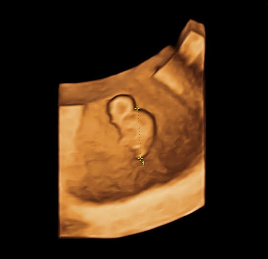 Qual é a diferença entre ultrassom 2D, 3D, 4D & 5D?