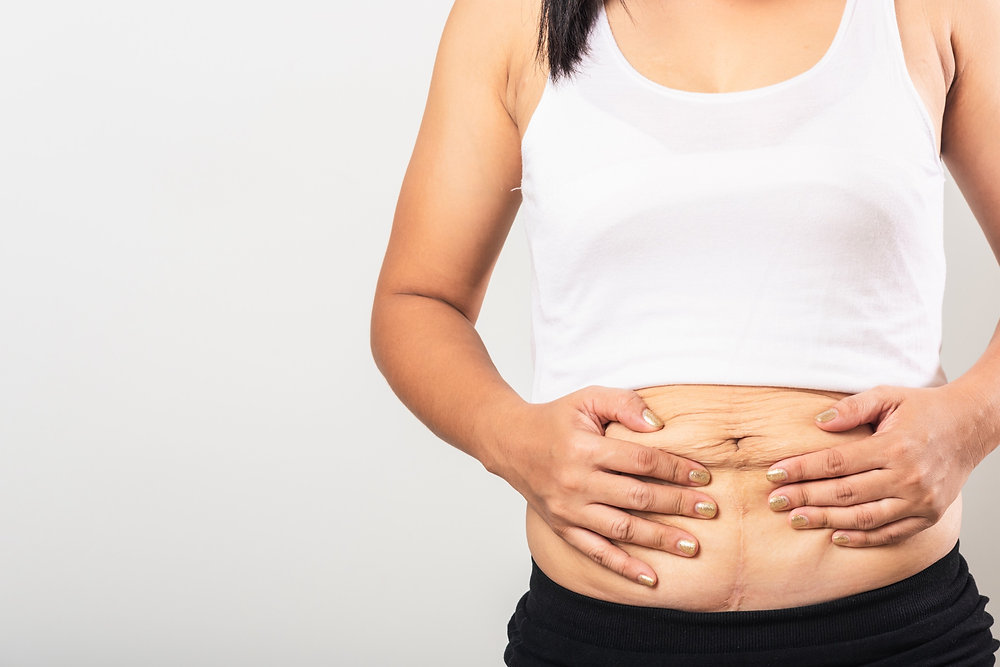 Key Differences in Tummy Tuck Techniques