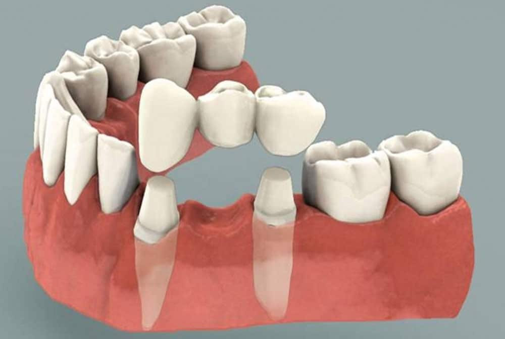 How Are Dental Crown and Bridges Beneficial?