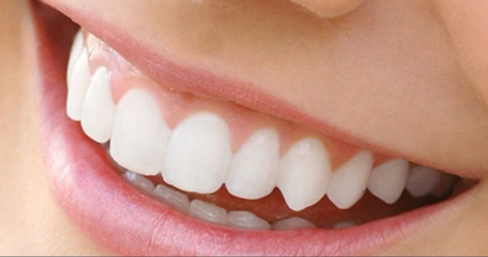 Maintain That Glow: Teeth Whitening Aftercare Secrets