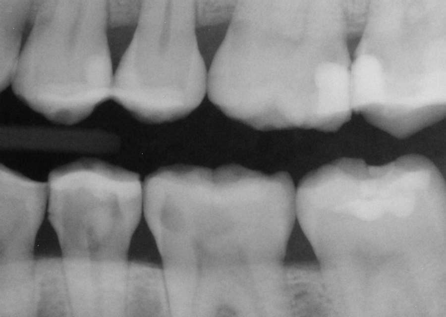 1 tooth, 2 x-rays?