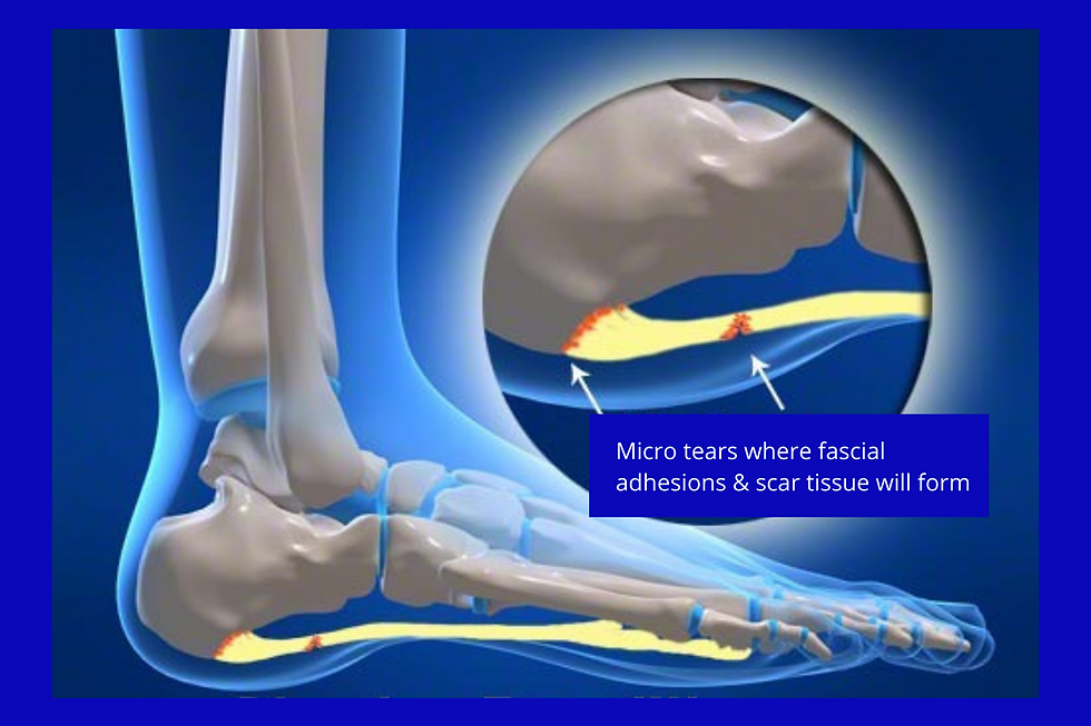 What Causes Plantar Fasciitis Scar Tissue?