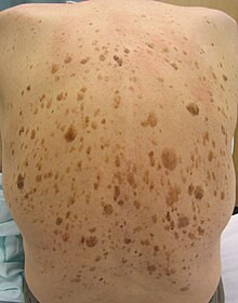 Seborrheic Keratosis | Expert Dermatologists | DermaSpaMed