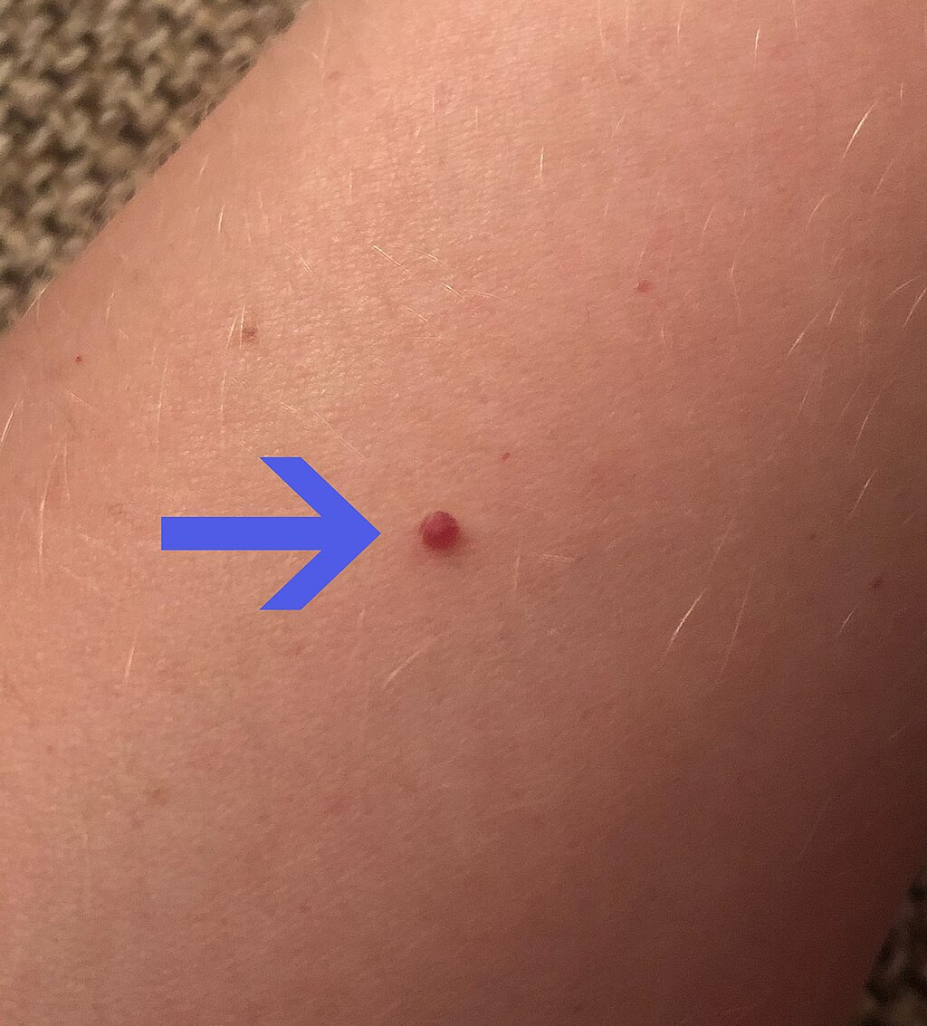 Cherry Angioma Relief | Expert Dermatologists | DermaSpaMed