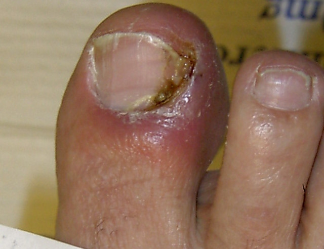 Ingrown Toenail Relief | Expert Dermatologists | DermaSpaMed
