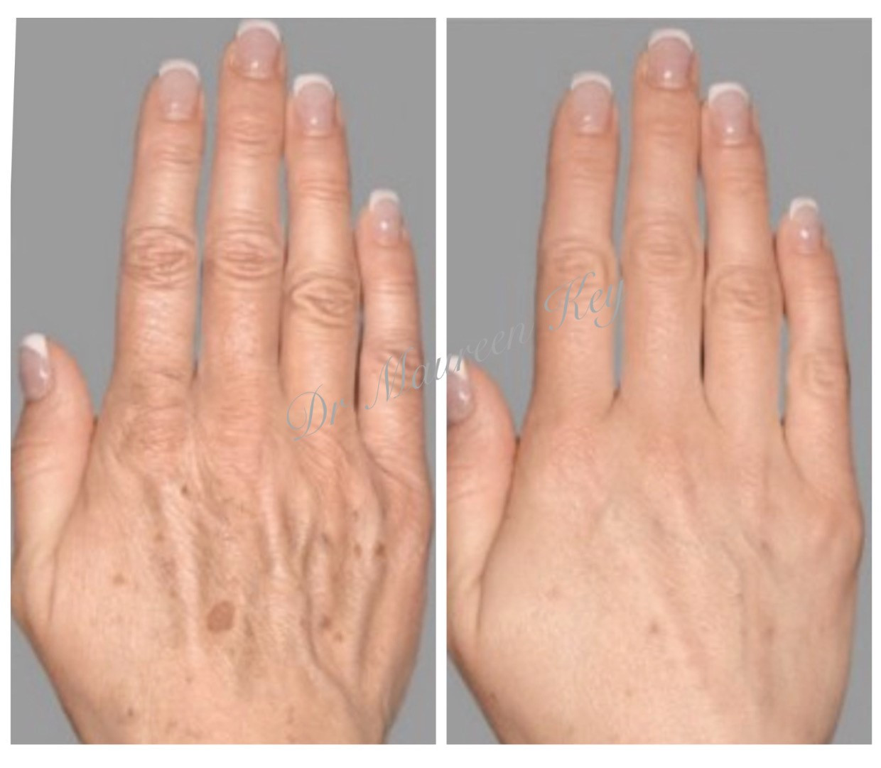 Hand Rejuvenation | Expert Dermatologists | DermaSpaMed